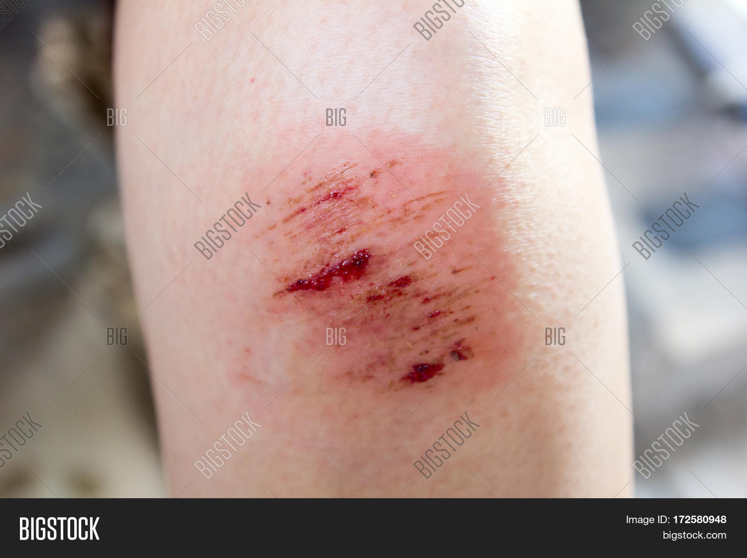 Bruised Wound Injury Image & Photo (Free Trial) | Bigstock