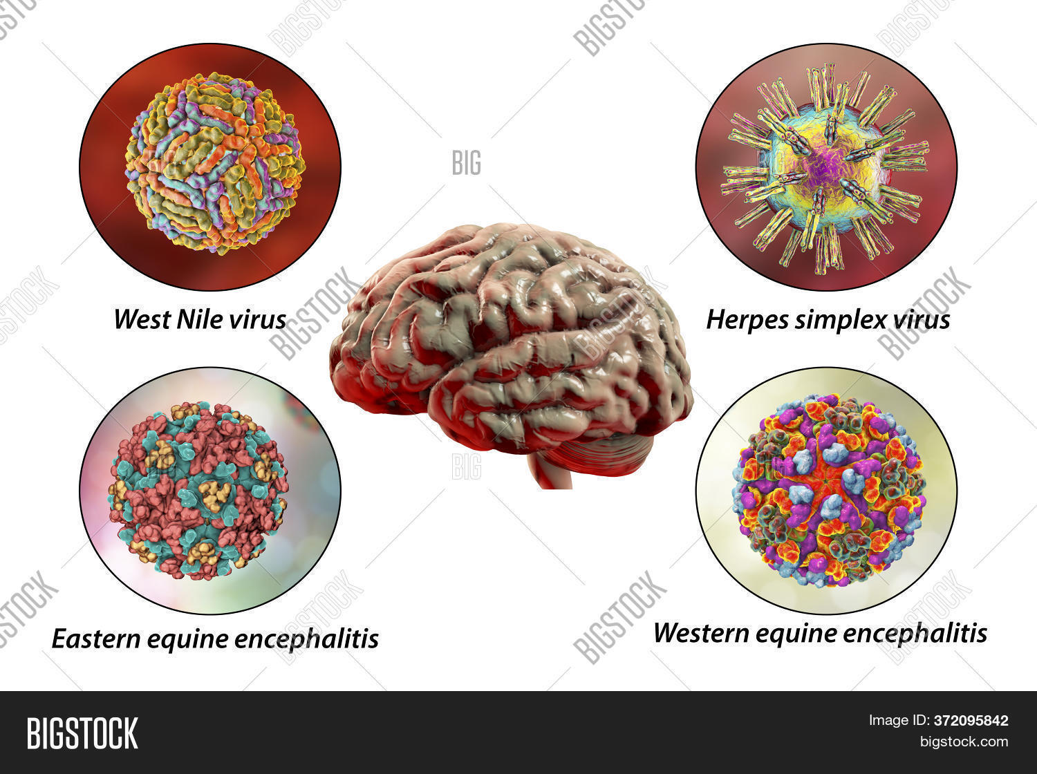 Brain Infections, Image & Photo (Free Trial) | Bigstock