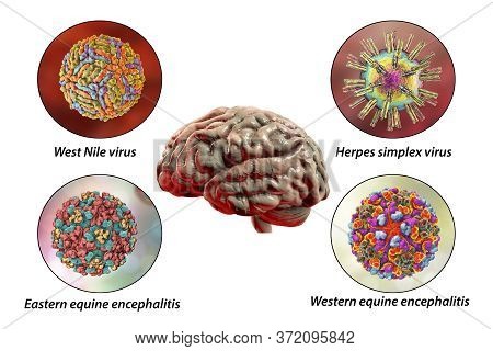 Brain Infections, Image & Photo (Free Trial) | Bigstock
