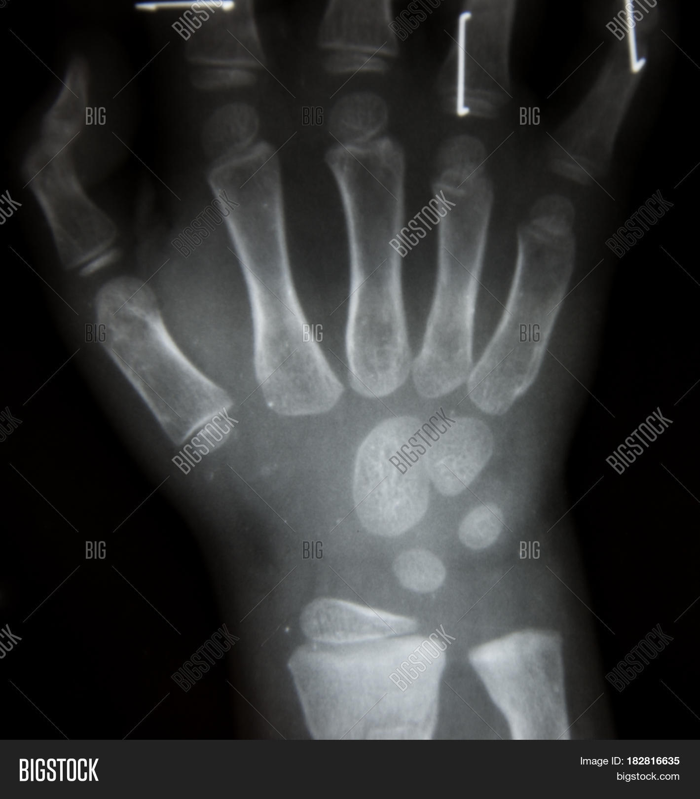 Film X-ray Both Hand Image & Photo (Free Trial) | Bigstock