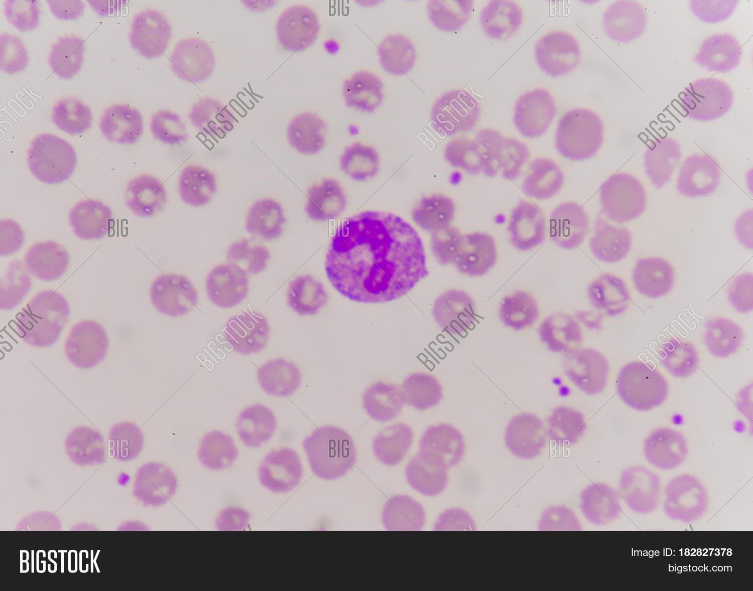 Abnormal Neutrophil Image & Photo (Free Trial) | Bigstock