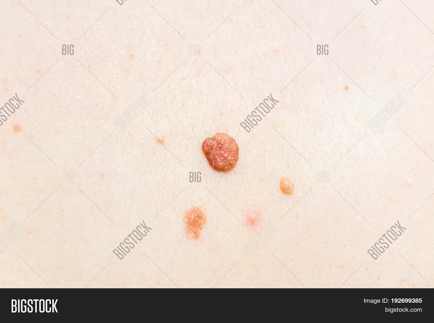 Woman Birthmark On Her Image & Photo (Free Trial) | Bigstock