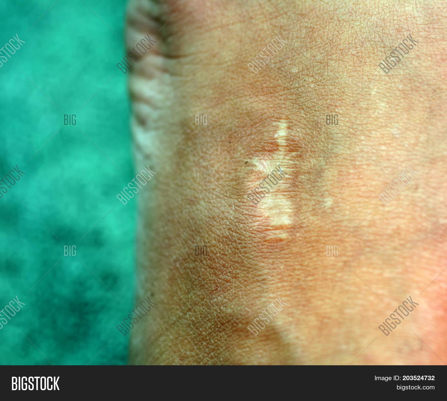 Scar On Skin. Image & Photo (Free Trial) | Bigstock