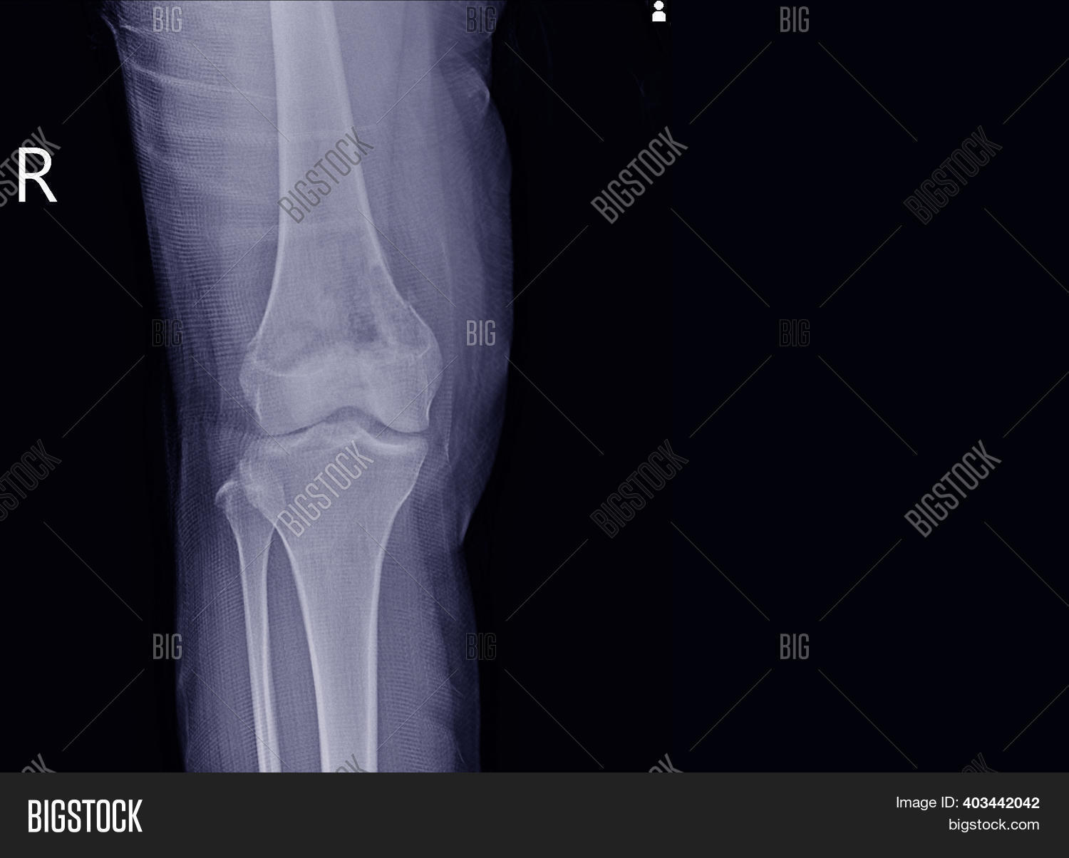 X-ray Knee Join Female Image & Photo (Free Trial) | Bigstock