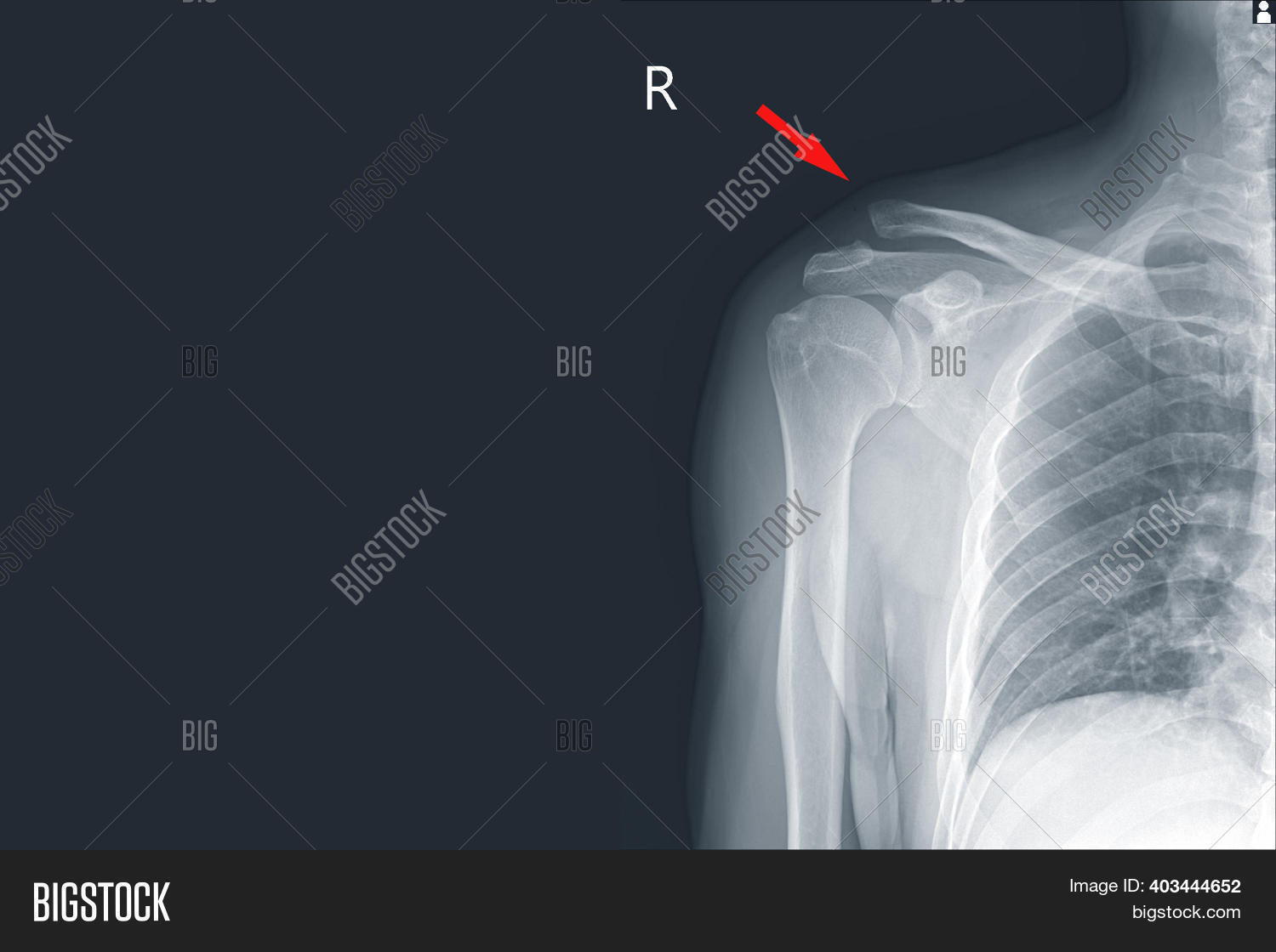 X-ray Right Shoulder Image & Photo (Free Trial) | Bigstock