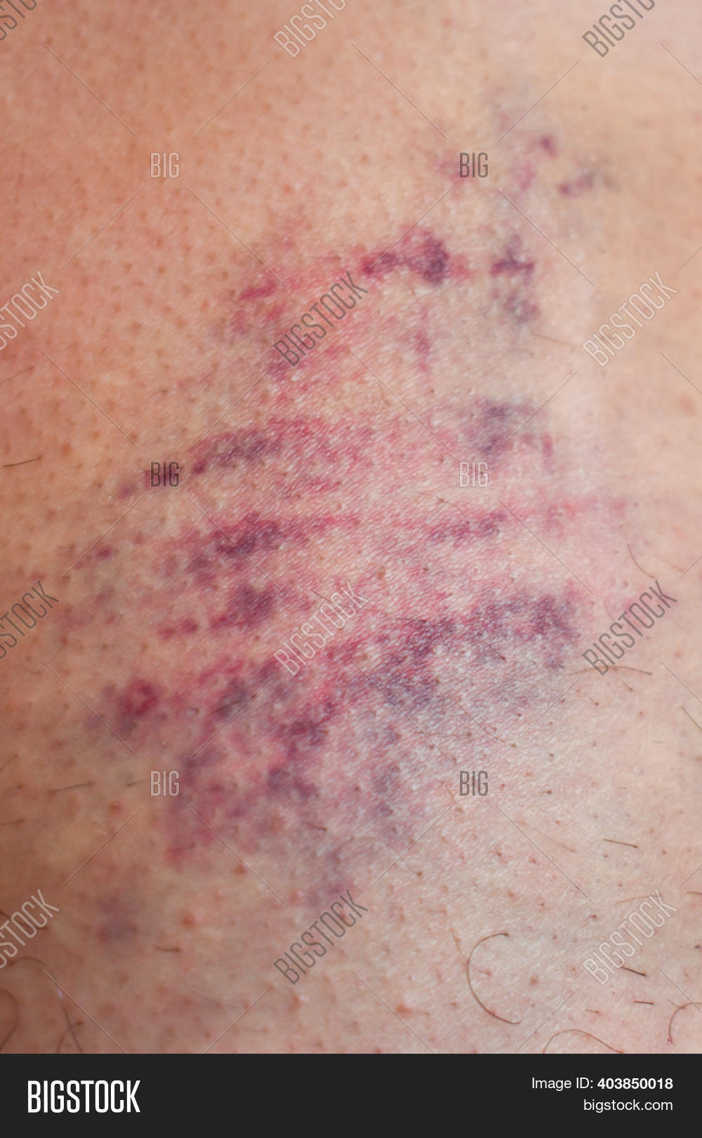 Bruise On Body. Close Image & Photo (Free Trial) | Bigstock
