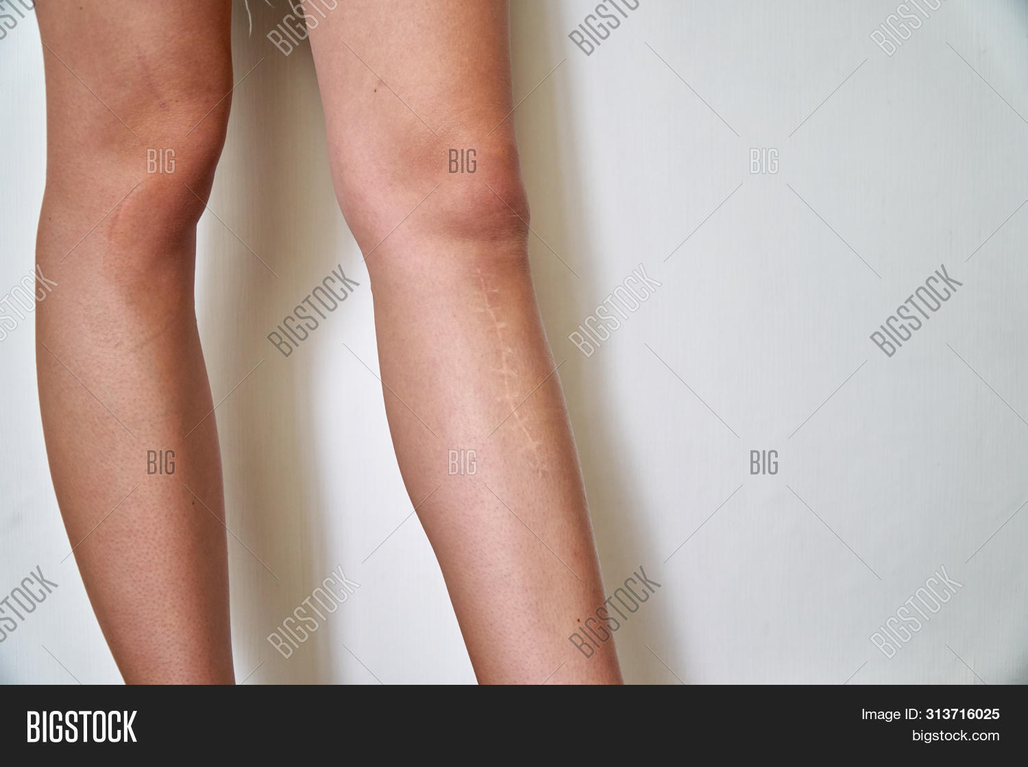 Scar On Leg. Bone Image & Photo (Free Trial) | Bigstock