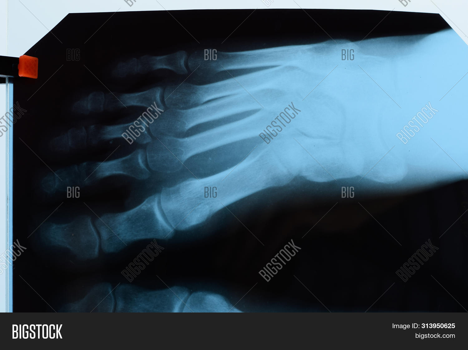 X-ray Toes. Foot On X- Image & Photo (Free Trial) | Bigstock
