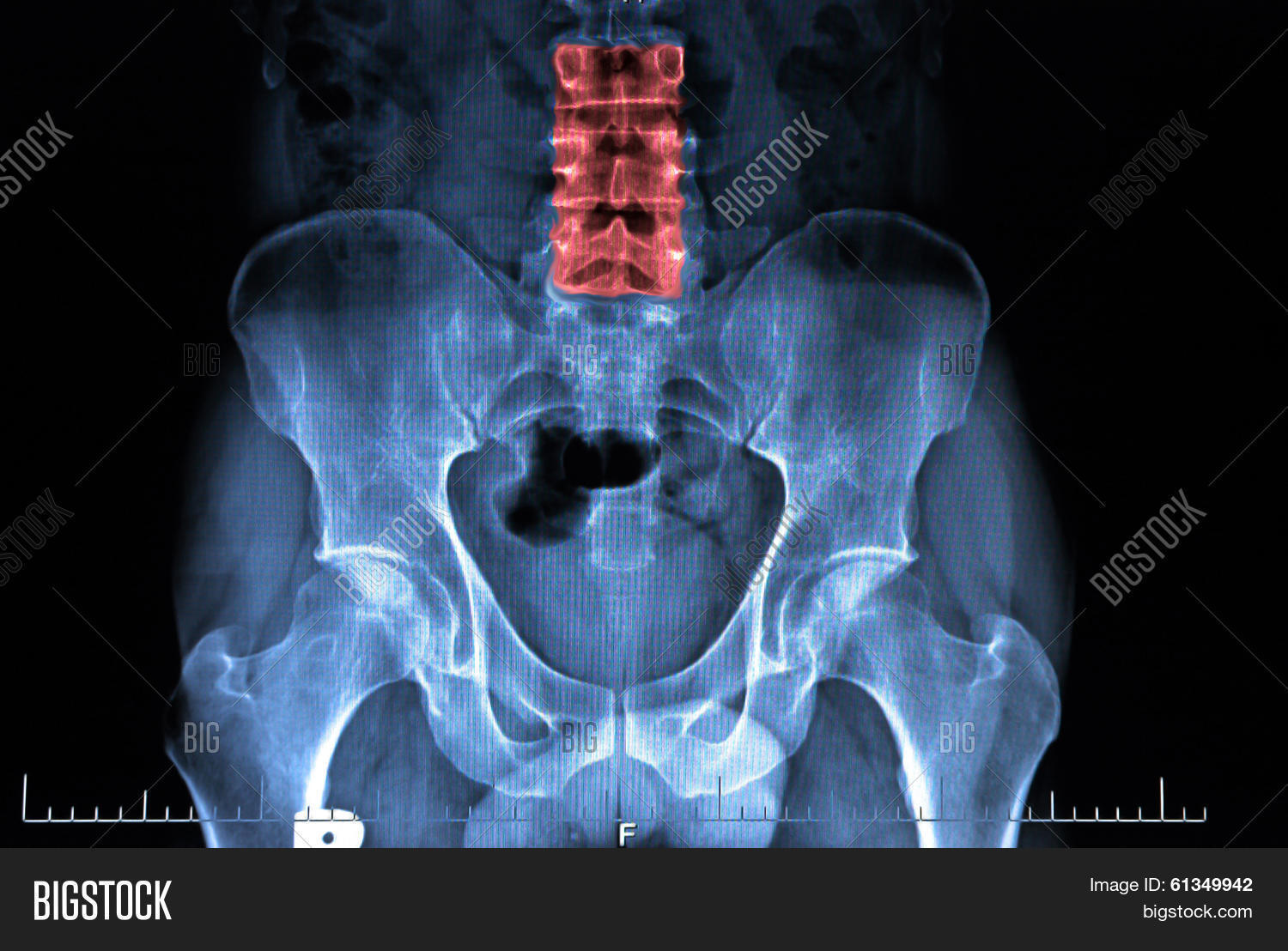 X Ray Inflammatory Image & Photo (Free Trial) | Bigstock