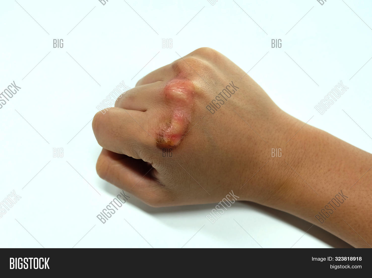 Scalded Hand Woman Image & Photo (Free Trial) | Bigstock