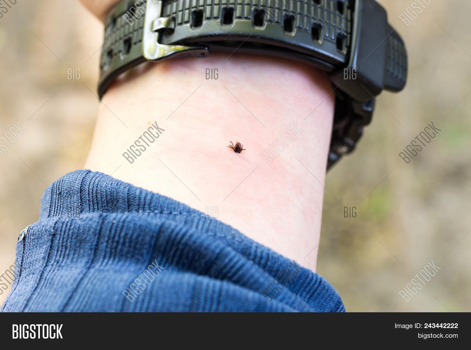 Imagen y foto Tick Bites His Hand (prueba gratis) | Bigstock