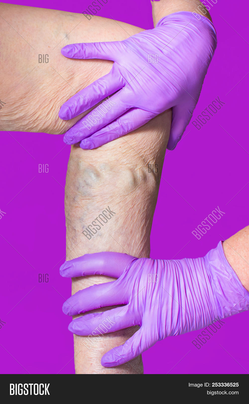 Lower Limb Vascular Image & Photo (Free Trial) | Bigstock