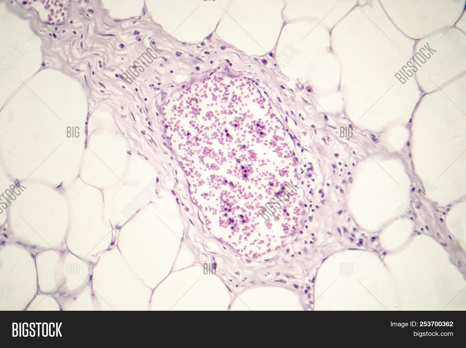 Lipoma, Benign Growth Image & Photo (Free Trial) | Bigstock