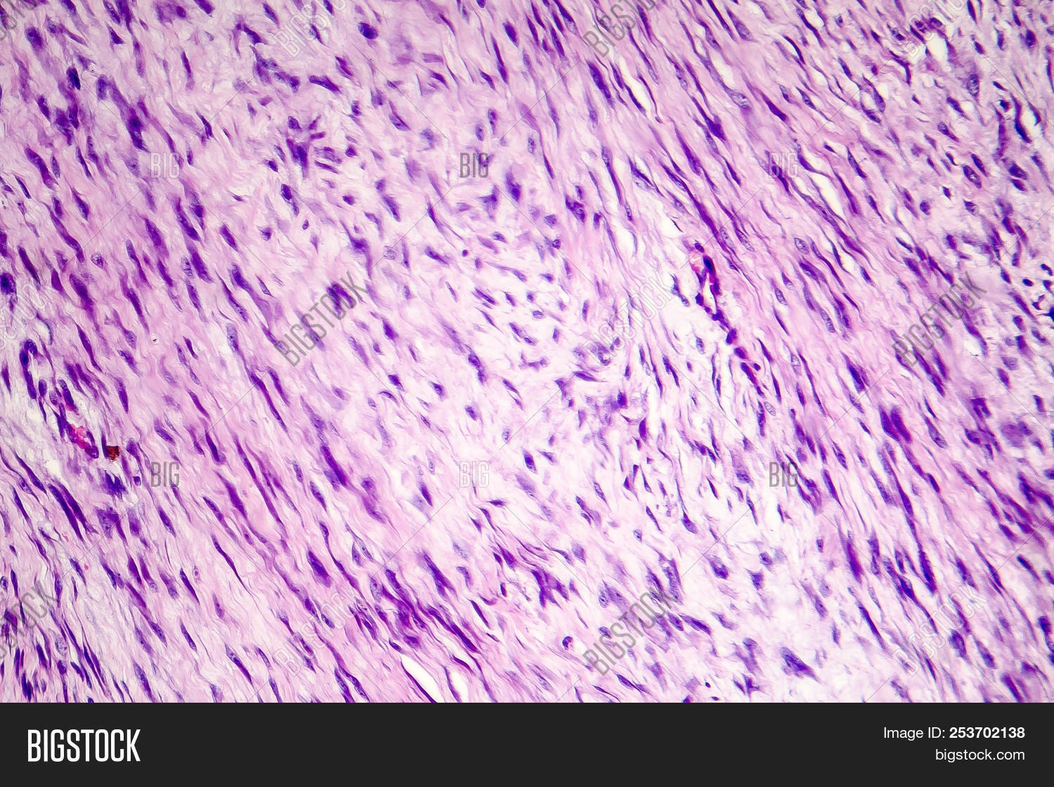 Fibroma, Benign Tumour Image & Photo (Free Trial) | Bigstock