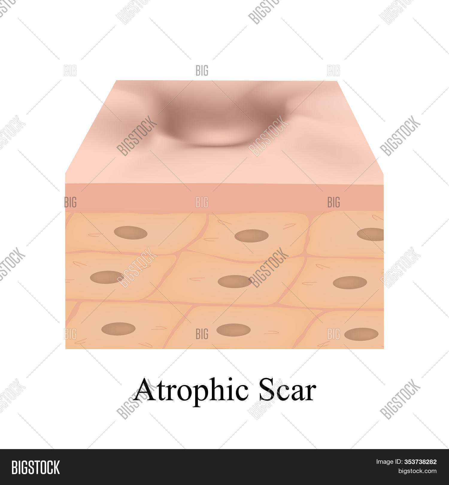 Atrophic Scars. Acne Image & Photo (Free Trial) | Bigstock