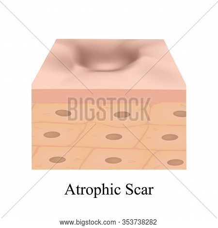 Atrophic Scars. Acne Image & Photo (Free Trial) | Bigstock