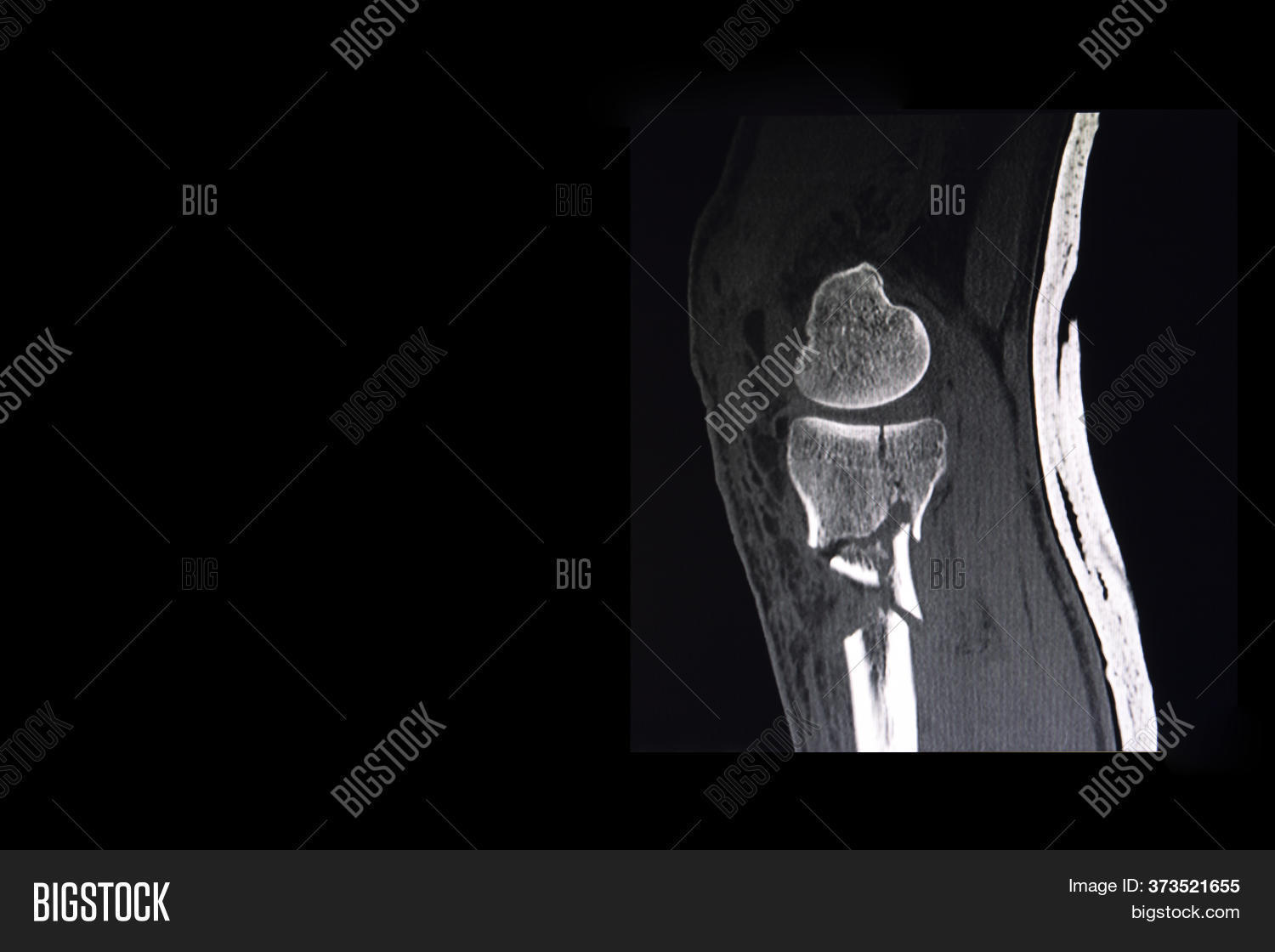 Ct Scan Knee Patient Image & Photo (Free Trial) | Bigstock