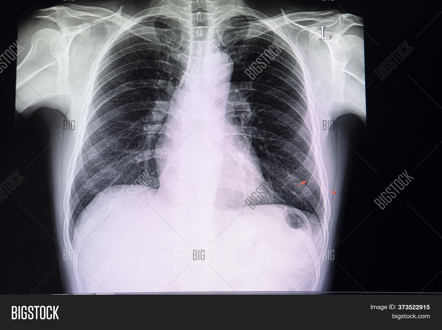 Chest Xray Film Image & Photo (Free Trial) | Bigstock
