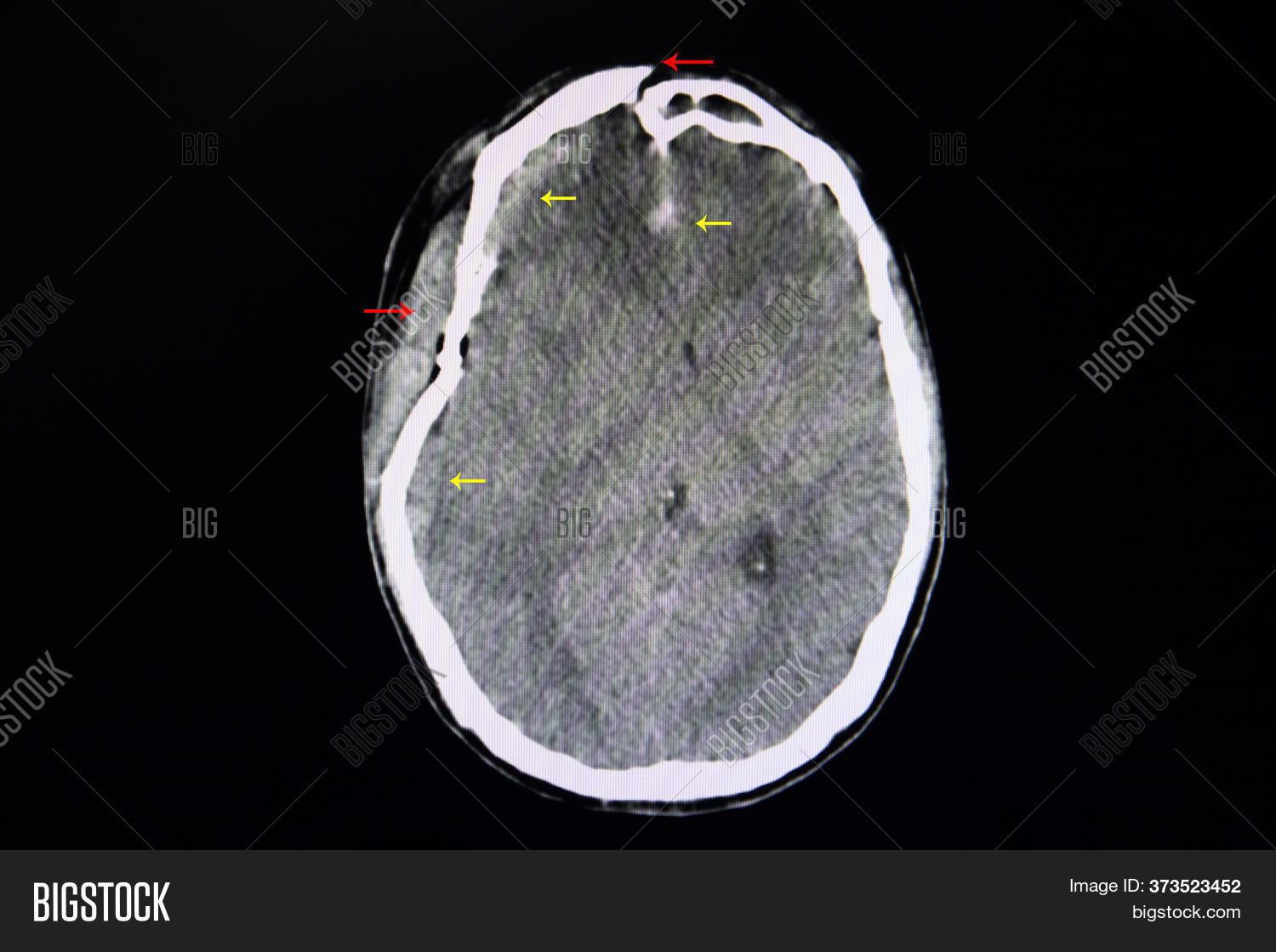 Ct Brain Patient Head Image & Photo (Free Trial) | Bigstock