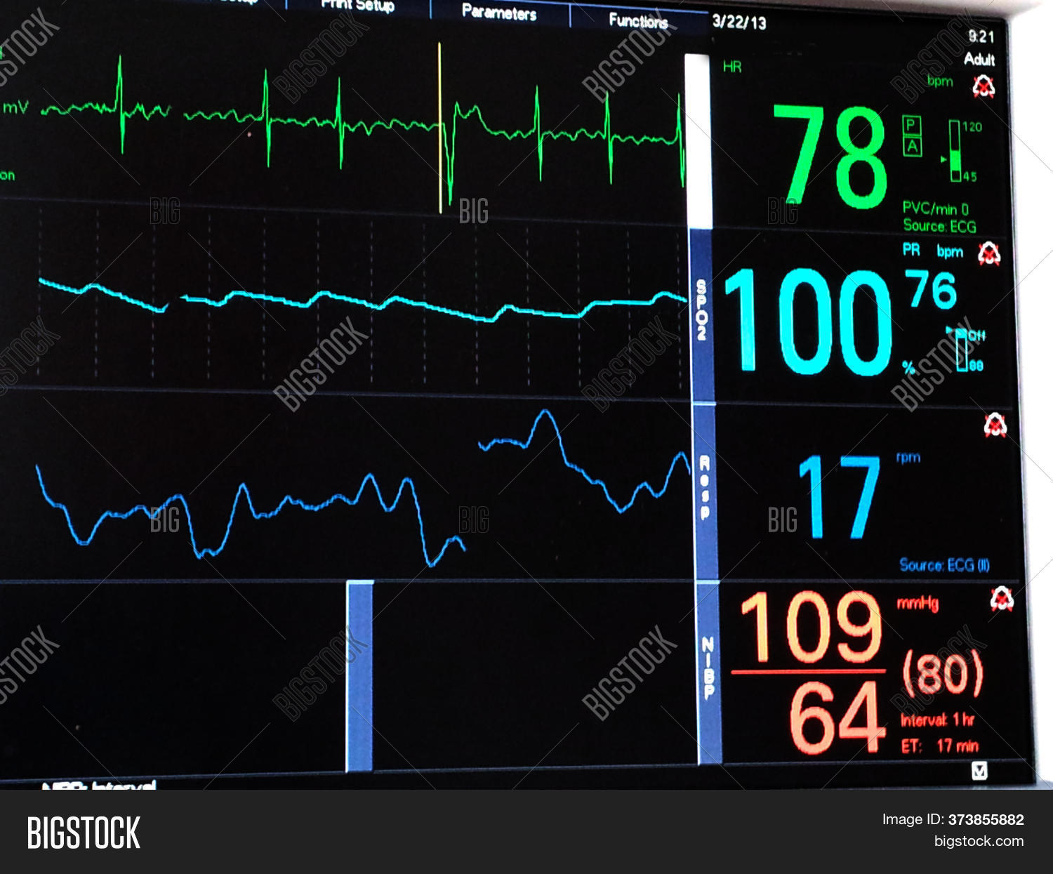 Hospital Heart Monitor Screen