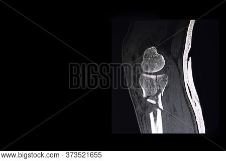 Ct Scan Knee Patient Image & Photo (Free Trial) | Bigstock