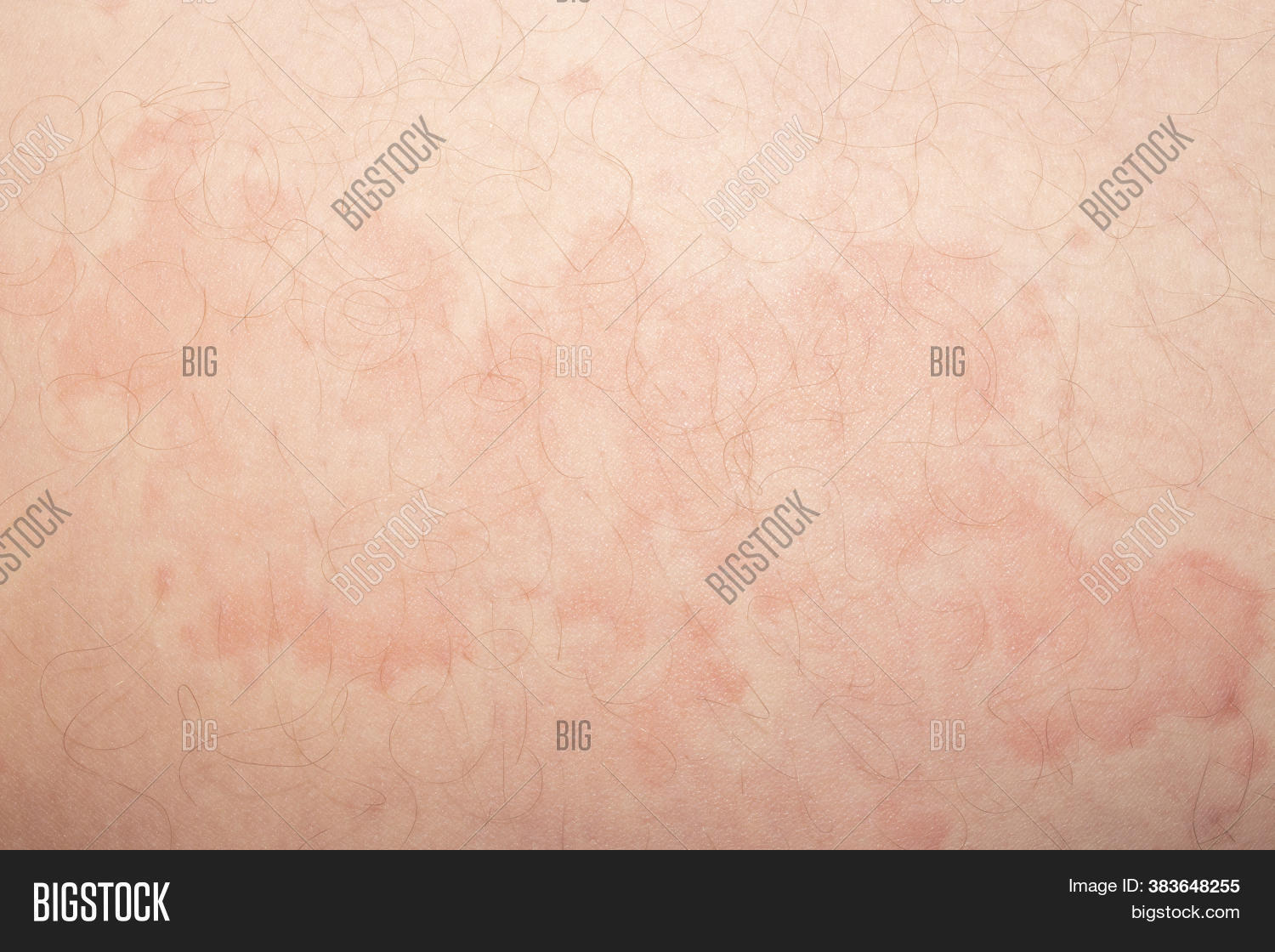 Skin Disease Urticaria Image & Photo (Free Trial) | Bigstock