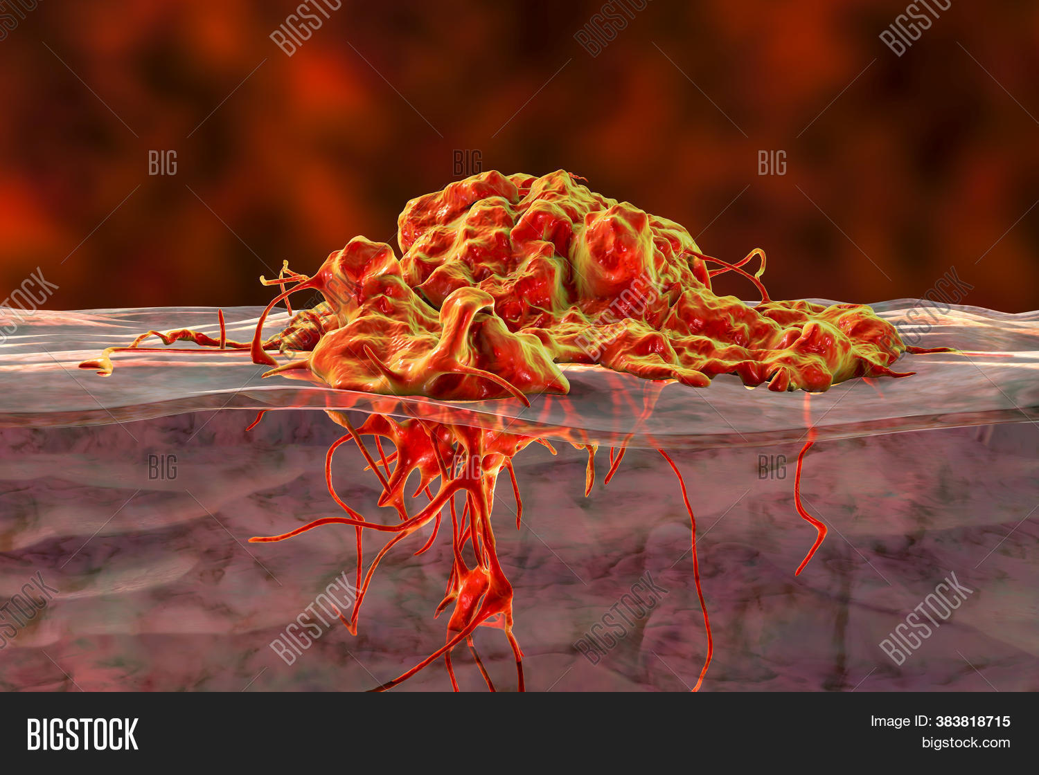 Invasive Cancer Growth Image & Photo (Free Trial) | Bigstock