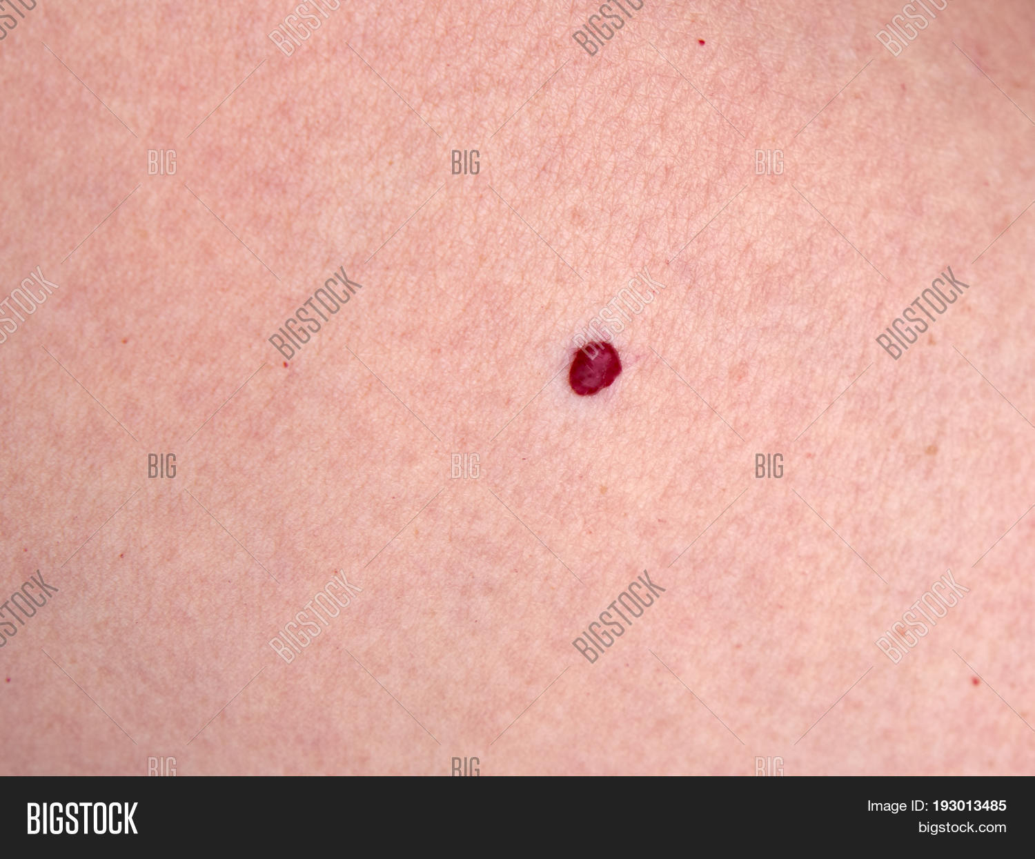 Imagen y foto Little Red Angioma (prueba gratis) | Bigstock