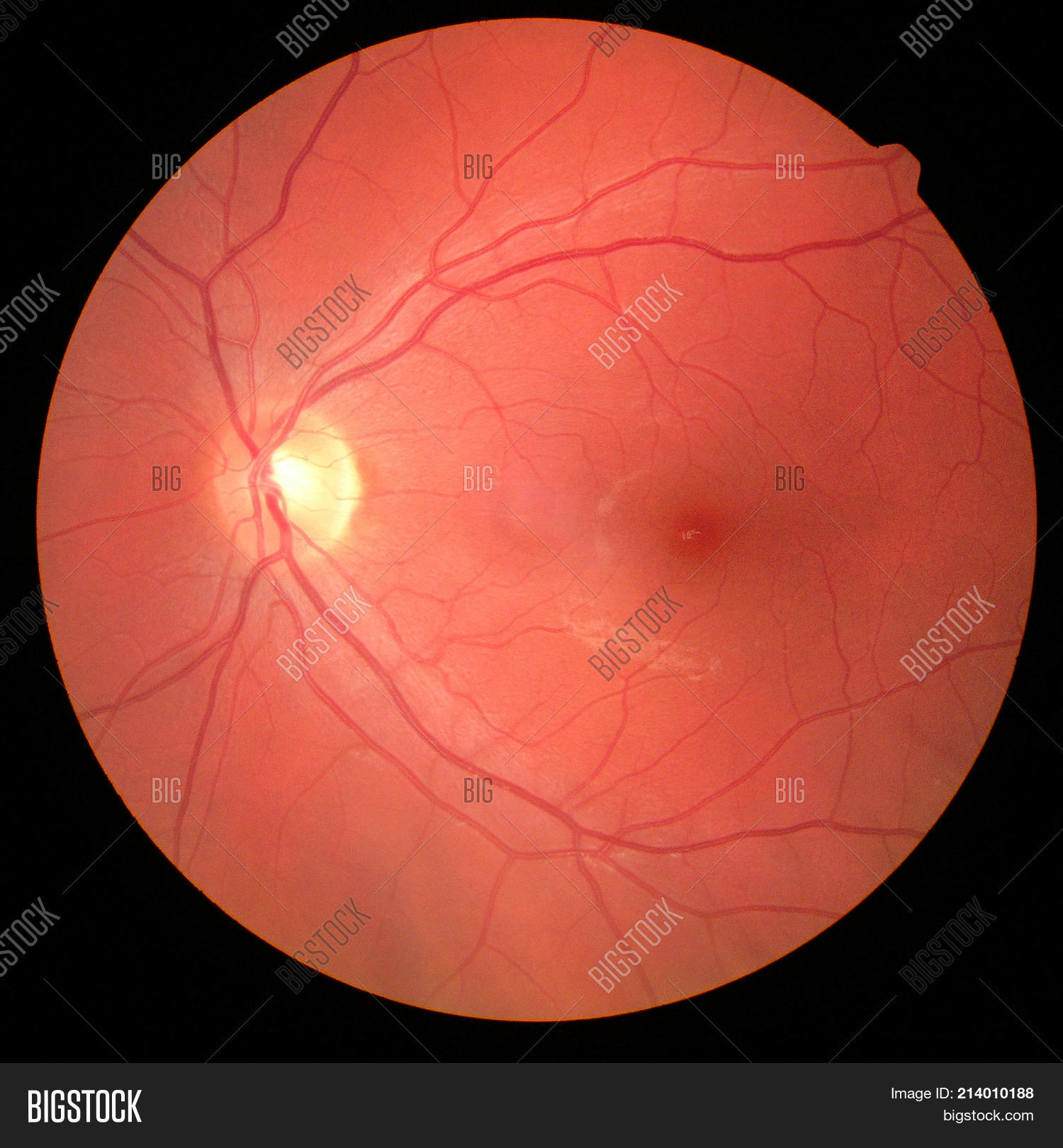 Right Eye's Retinal Image & Photo (Free Trial) | Bigstock
