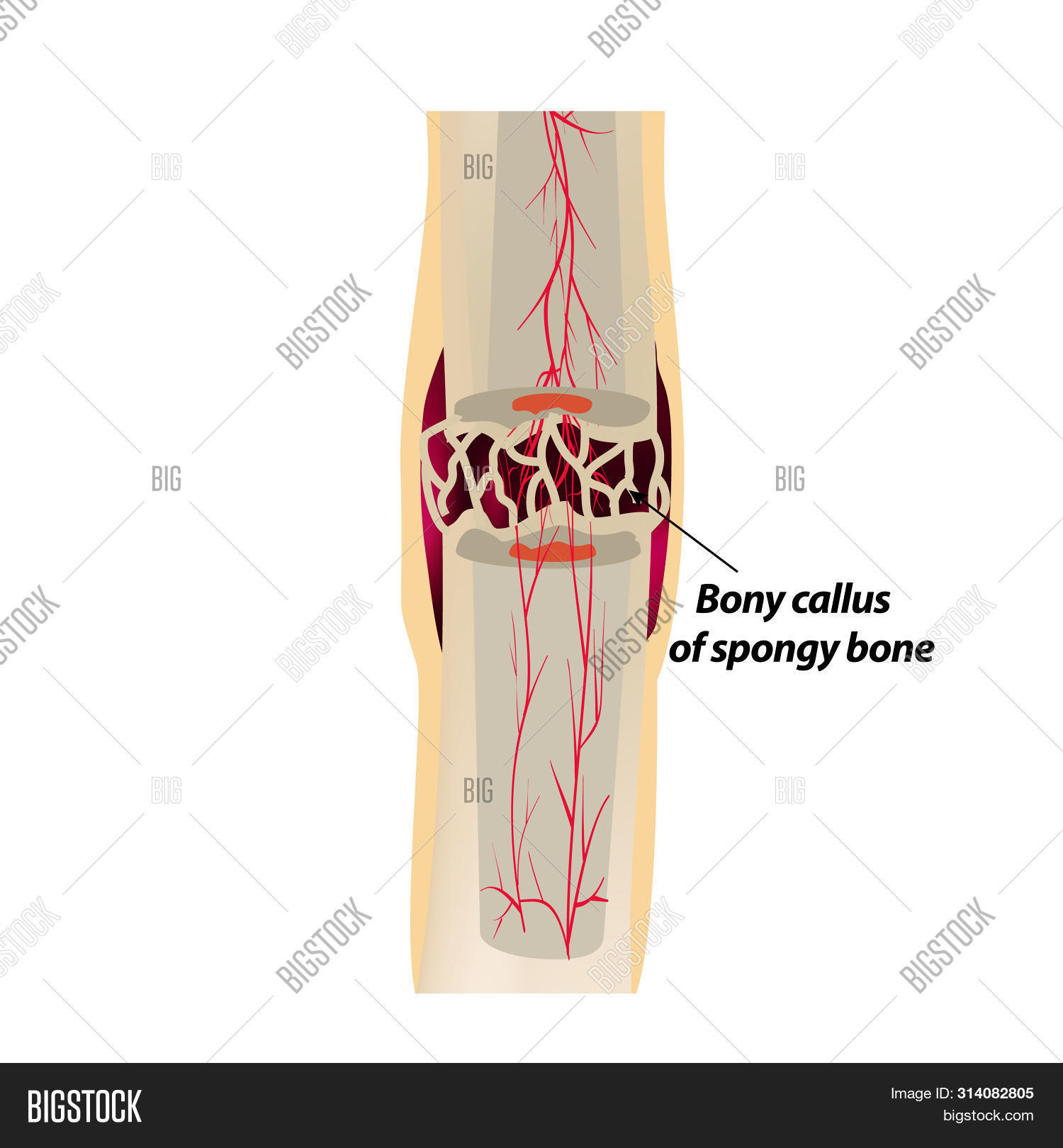 3 Stage Healing Bone Image & Photo (Free Trial) | Bigstock