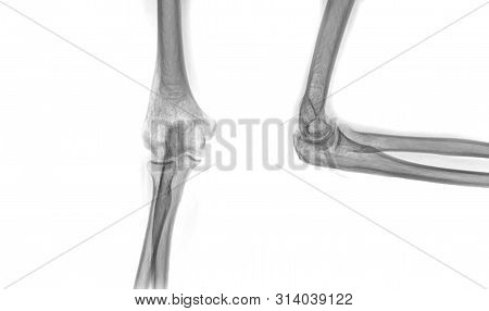 X-ray Elbow Image & Photo (Free Trial) | Bigstock