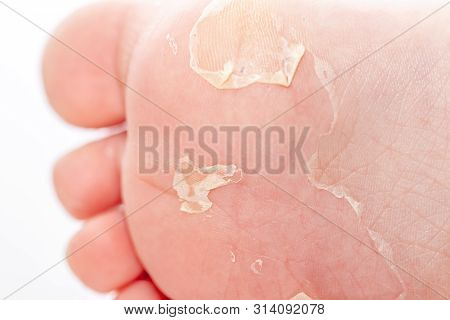 After Red Rash Image & Photo (Free Trial) | Bigstock