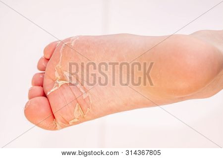 After Red Rash Image & Photo (Free Trial) | Bigstock