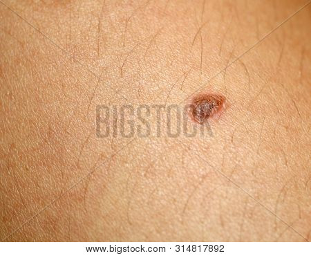 Burn On Skin. Blister Image & Photo (Free Trial) | Bigstock