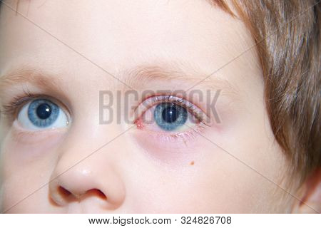 Conjunctivitis Eye Image & Photo (Free Trial) | Bigstock