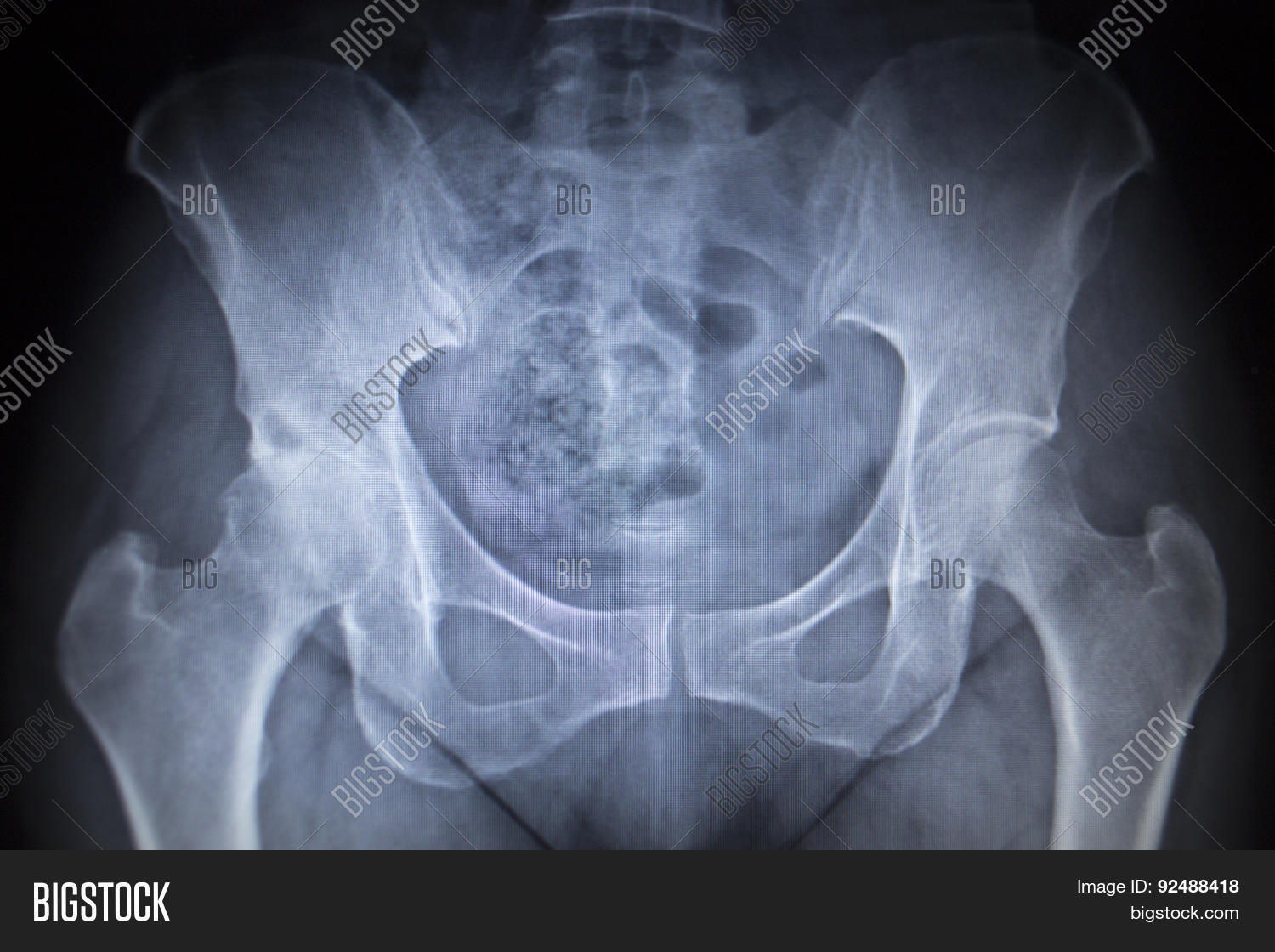 X-ray Orthopedic Scan Image & Photo (Free Trial) | Bigstock