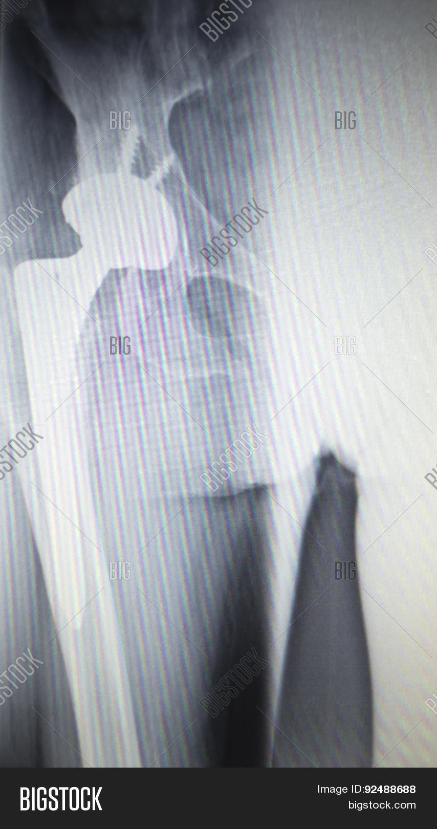 X-ray Scan Image Hip Image & Photo (Free Trial) | Bigstock