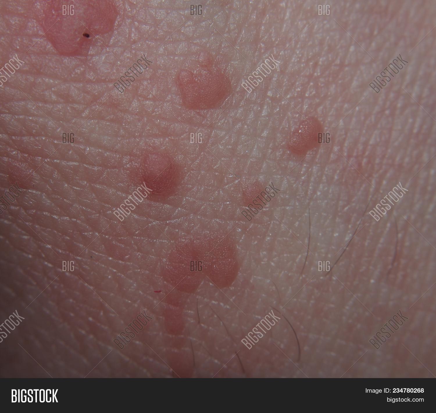 Warts On Skin Human Image & Photo (Free Trial) | Bigstock