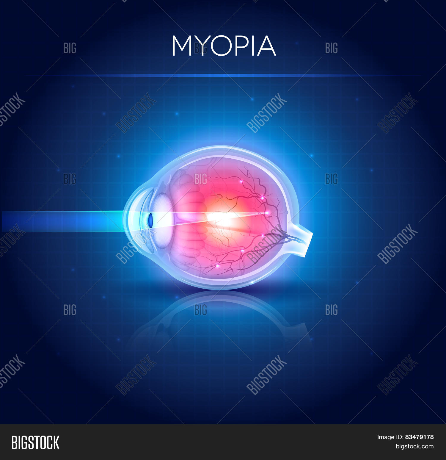 Myopia Eyesight Vector & Photo (Free Trial) | Bigstock