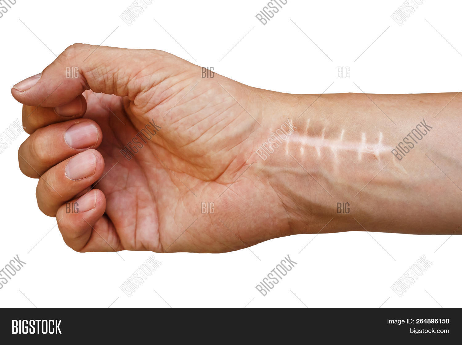 Scar Stitches On Wrist Image & Photo (Free Trial) | Bigstock