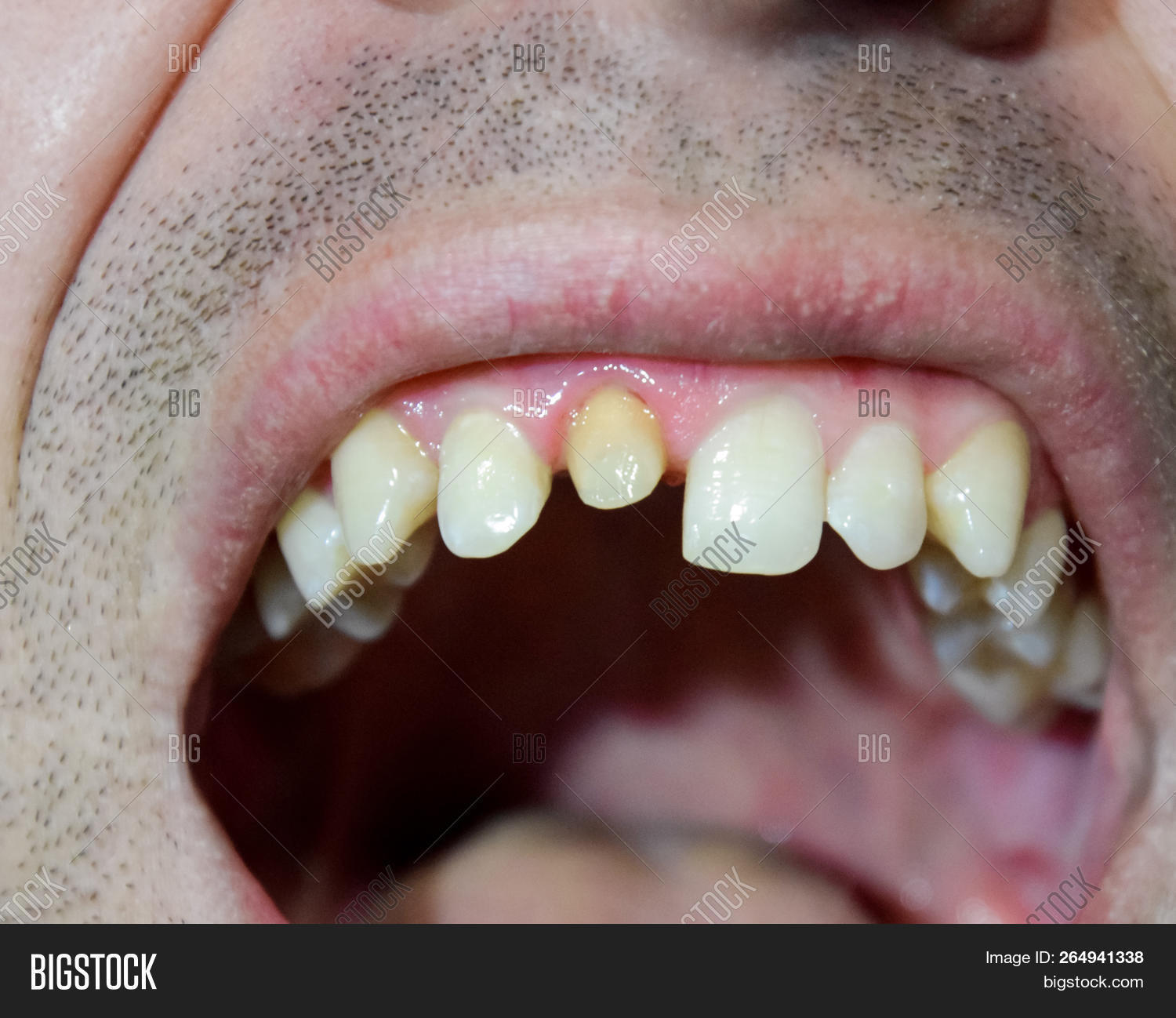 Process Replacing Image & Photo (Free Trial) | Bigstock