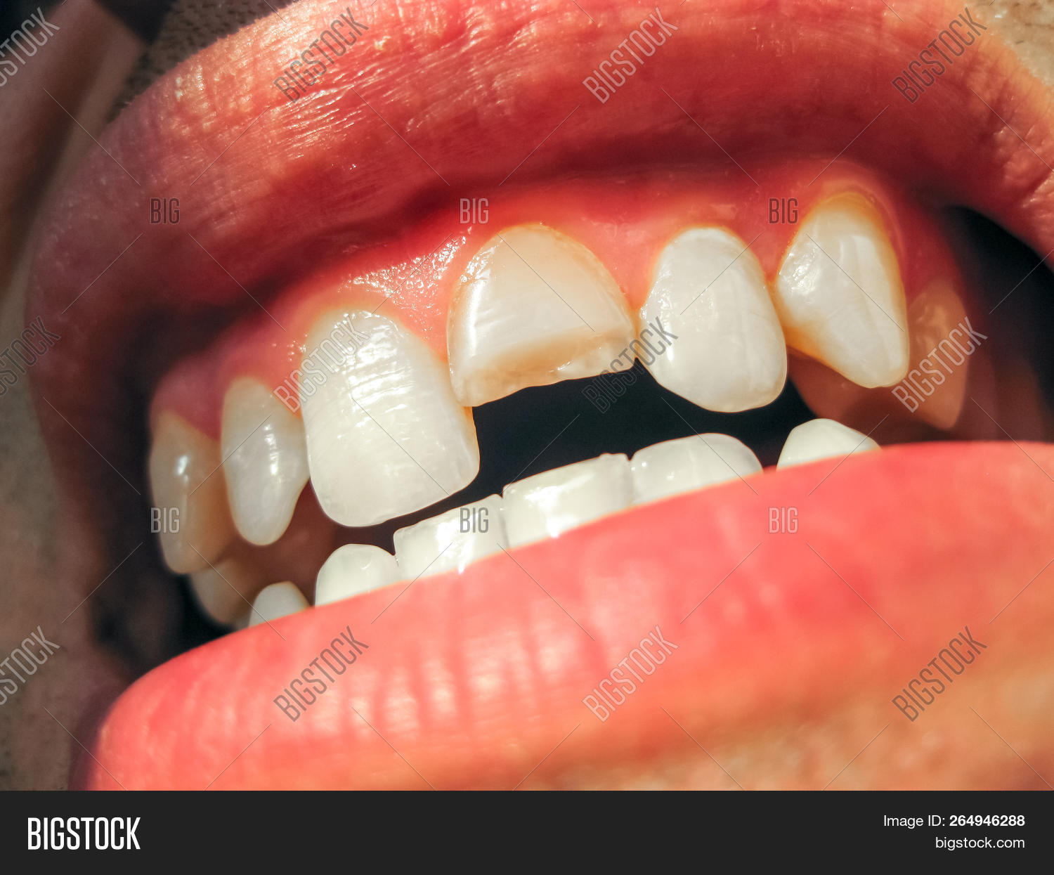 Broken Tooth. Broken Image & Photo (Free Trial) | Bigstock