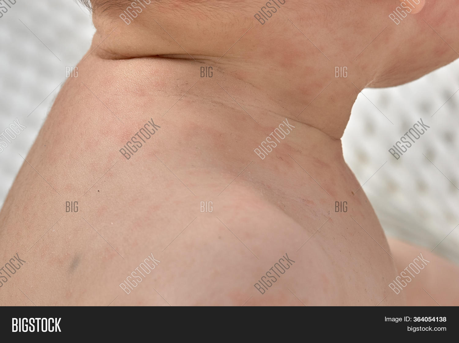 Roseola Rash Viral Image & Photo (Free Trial) | Bigstock