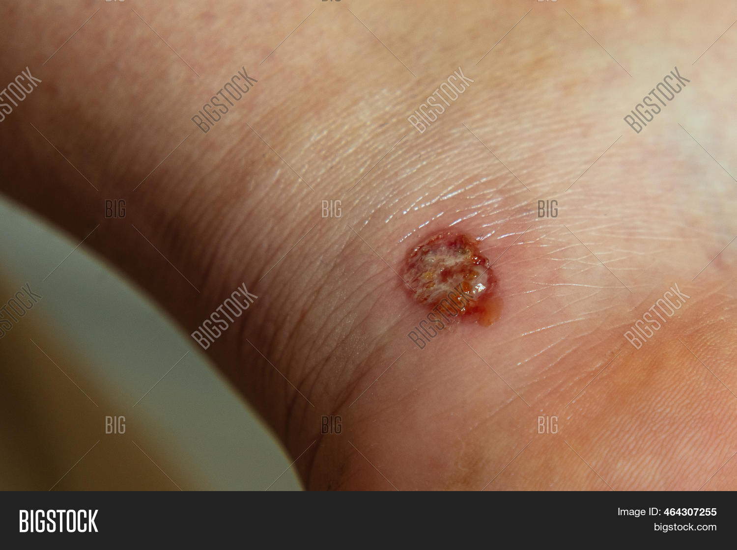 Oozing Wound Blood On Image & Photo (Free Trial) | Bigstock