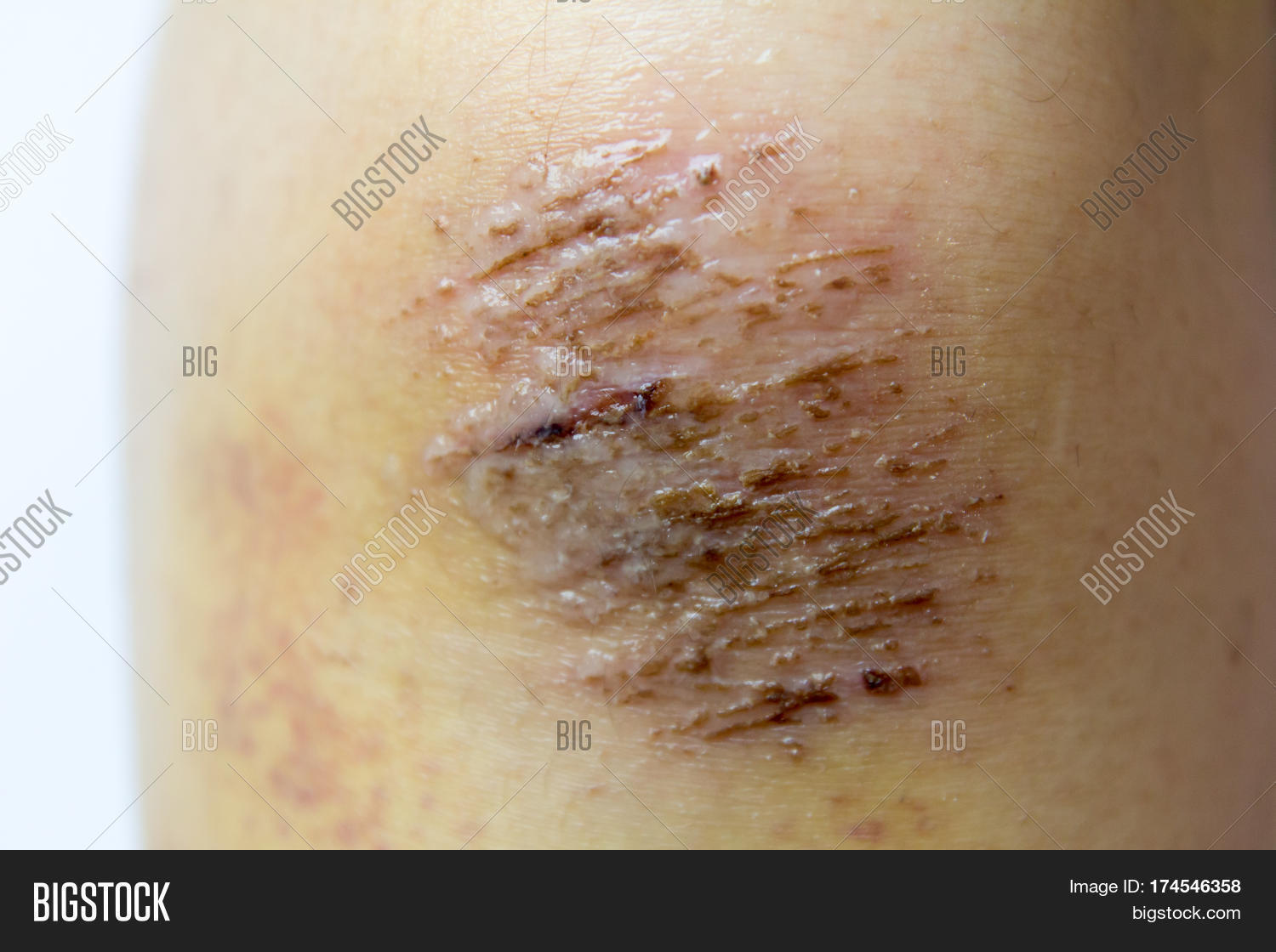 Closed Red Scab Injury Image & Photo (Free Trial) | Bigstock