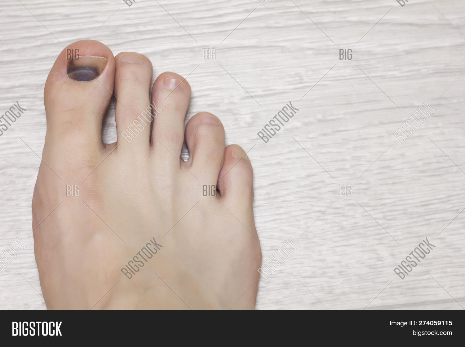 Injury Nail On Foot, Image & Photo (Free Trial) | Bigstock