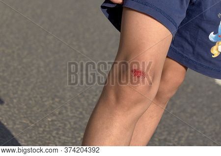 Bruised Wound On Knee Image & Photo (Free Trial) | Bigstock