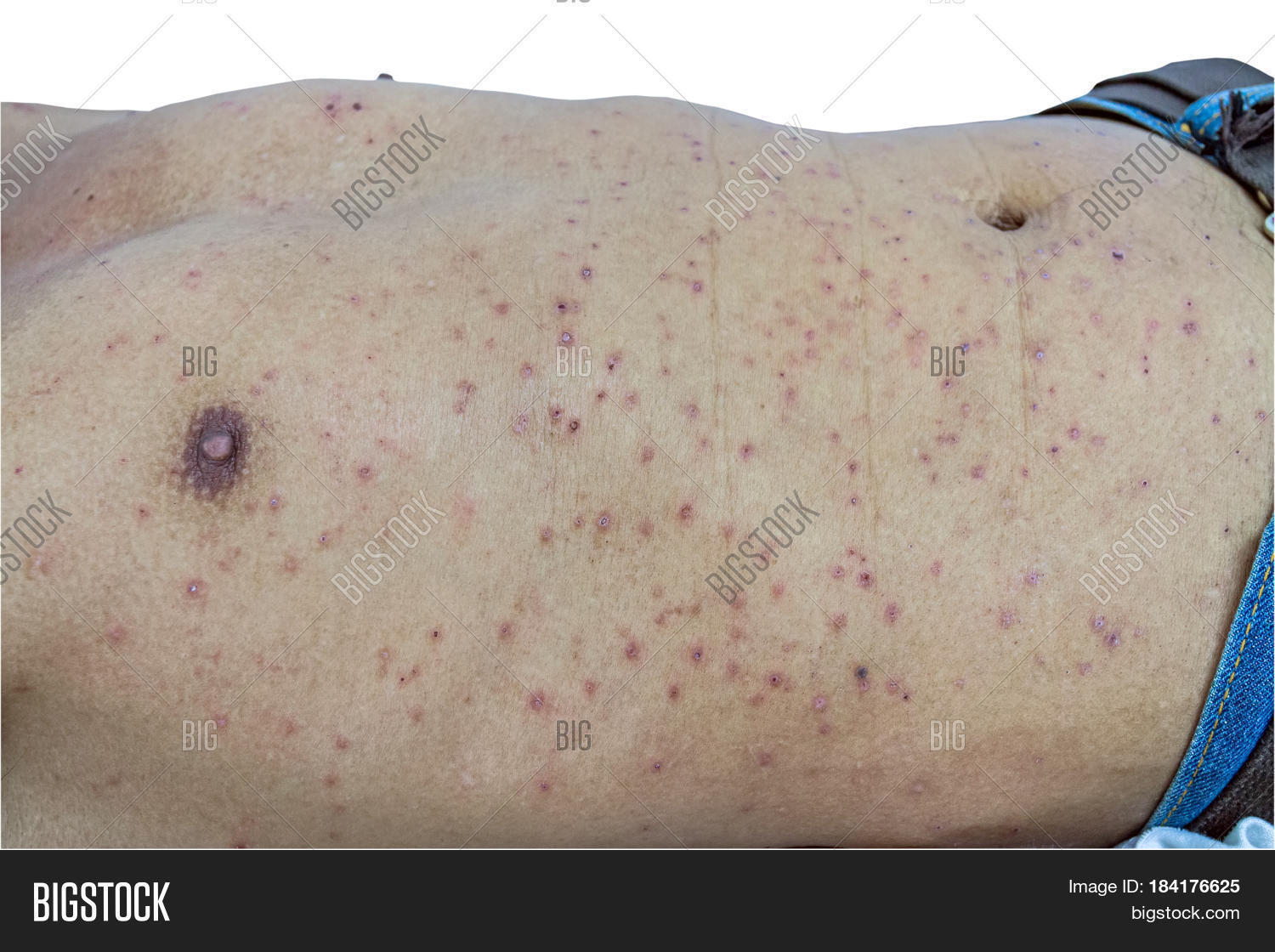 Close Man Papule Rash Image & Photo (Free Trial) | Bigstock
