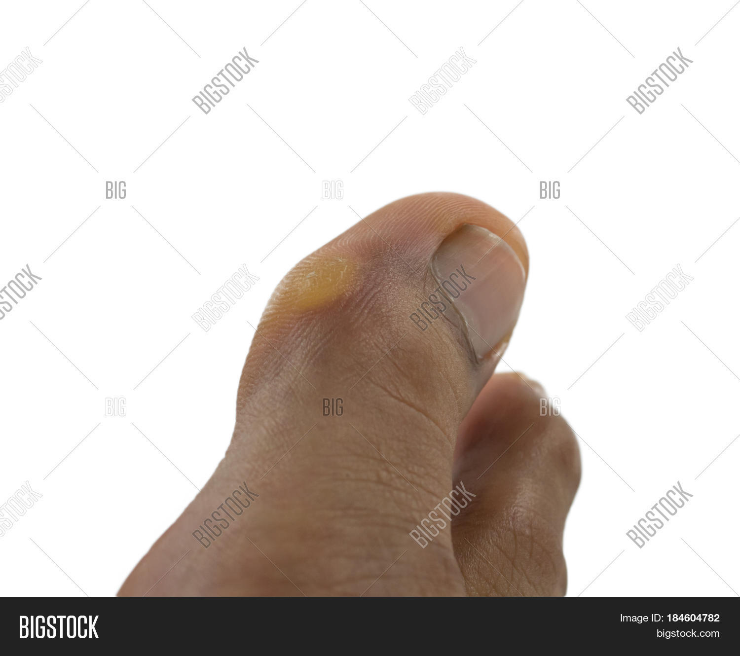 Position Callus On Image & Photo (Free Trial) | Bigstock
