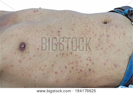 Close Man Papule Rash Image & Photo (Free Trial) | Bigstock